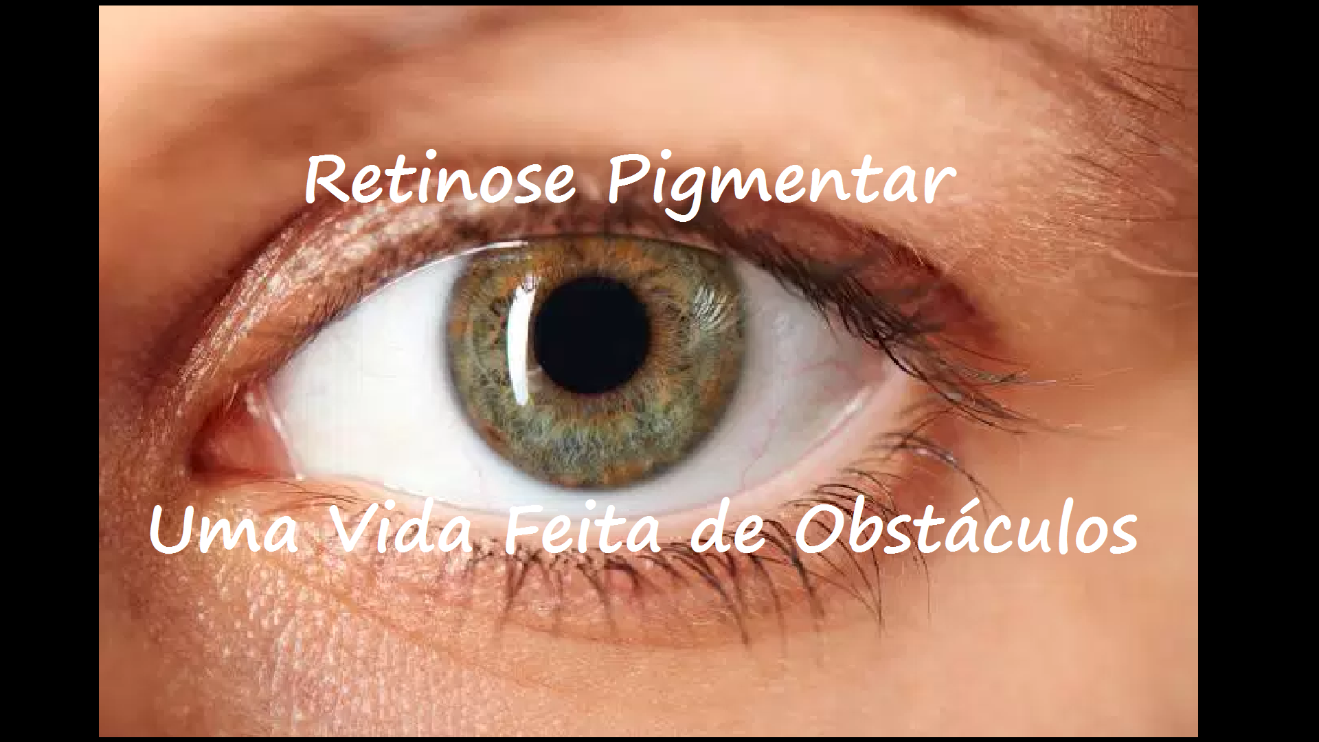 Retinopatia: Ultimos prazeres de um Cego | PPL